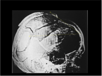 A Review of the JFK Cranial x-Rays and Photographs | Assassination of JFK