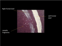 A Review of the JFK Cranial x-Rays and Photographs | Assassination of JFK